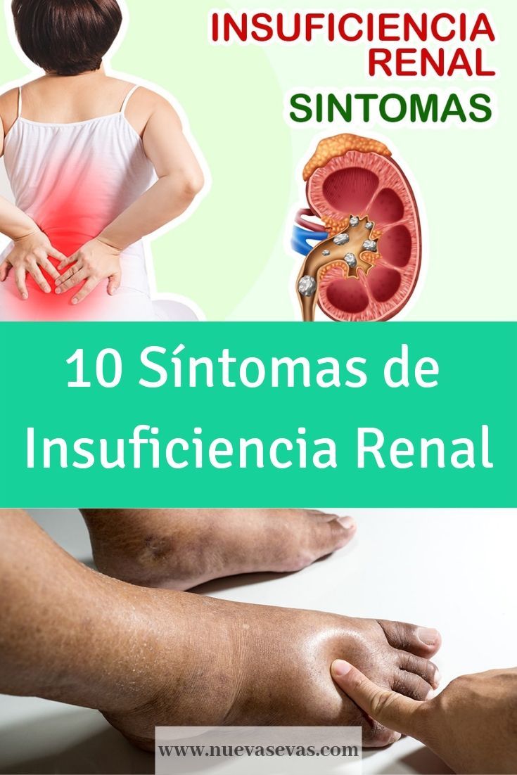 10 Síntomas de Insuficiencia Renal y Riñones Inflamados | Nuevas Evas